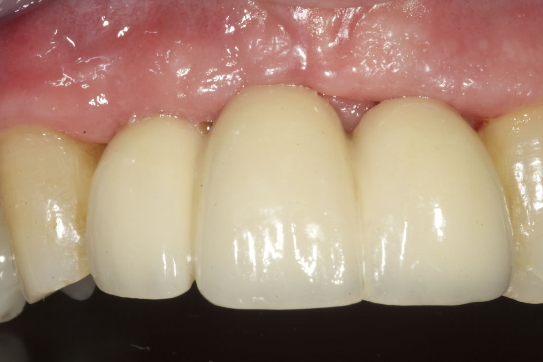 Upper Implant Rehabilitation - Cirencester Dental Practice